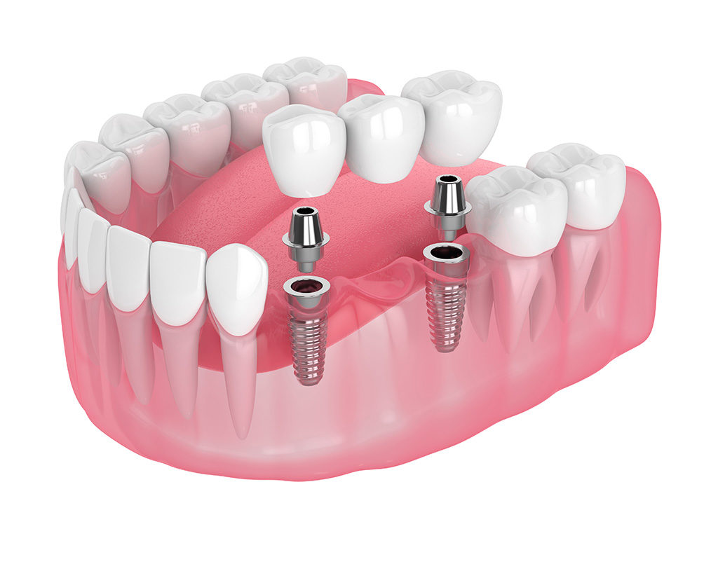 Teeth Replacement Options - Shine Dental Associates Teeth Replacement Options - Shine Dental Associates