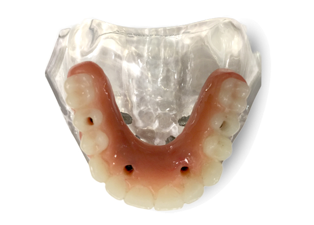Implant Supported Partial Dentures
